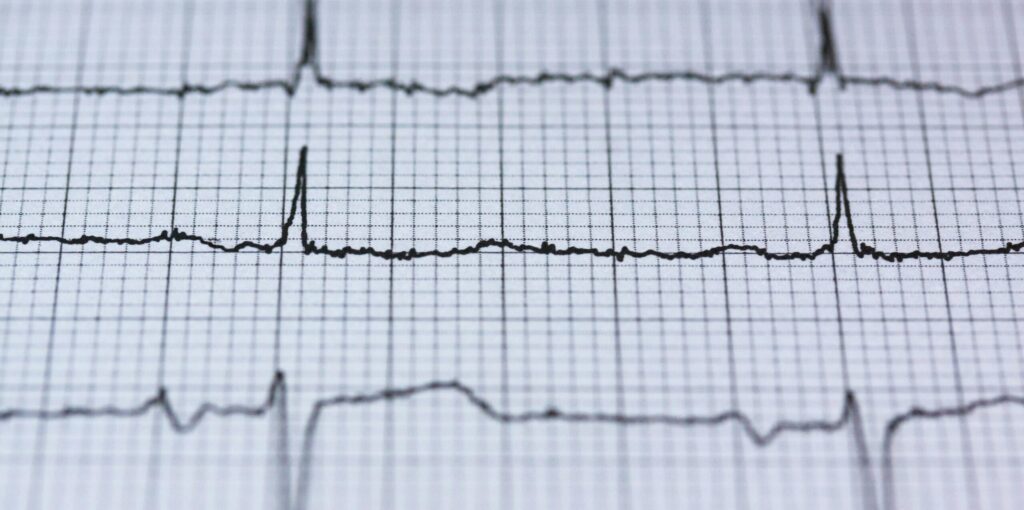 The Role of ECG Analysis Online in Modern Cardiac Care