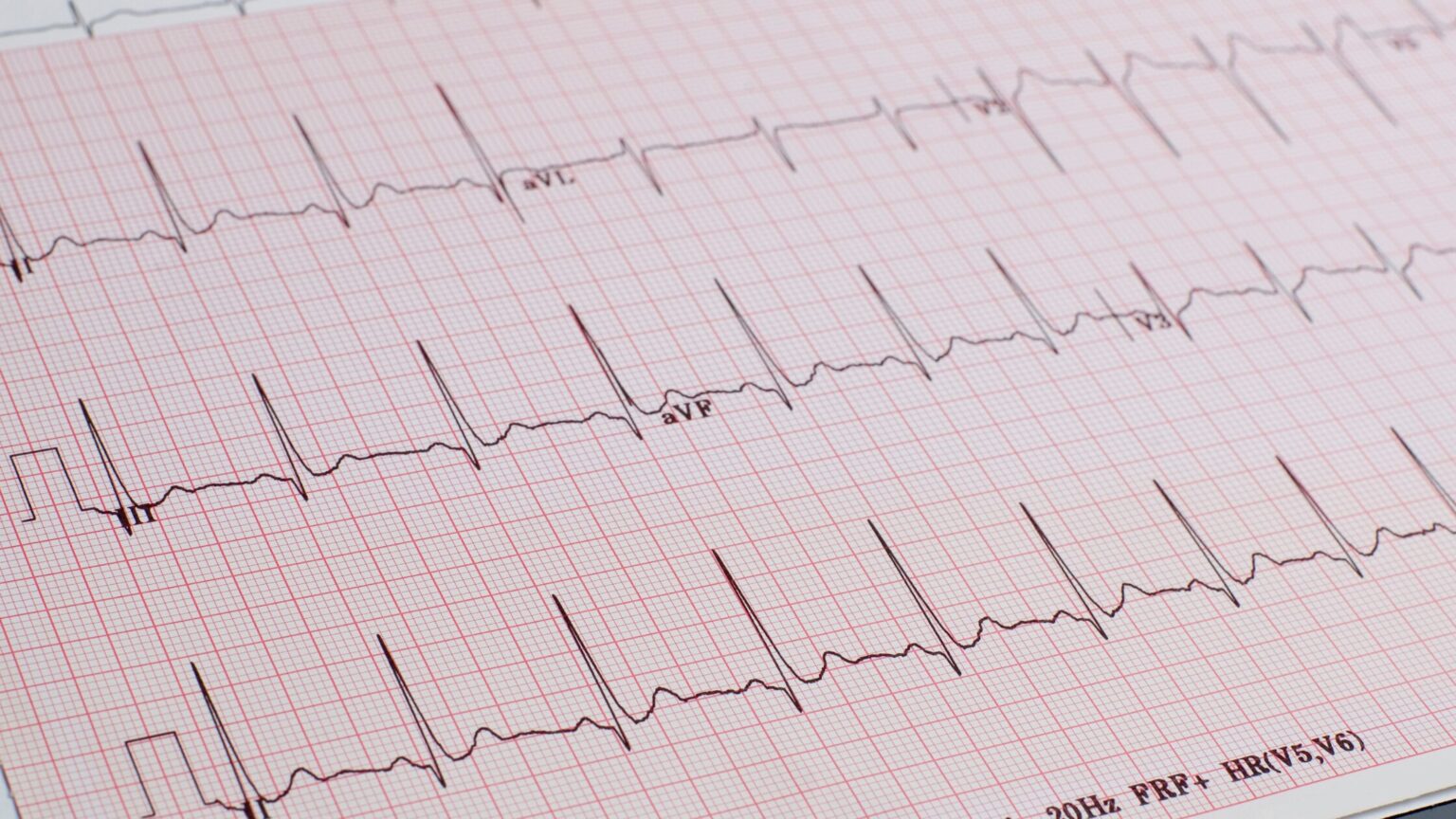 What Is an ECG Test and What Do the Results Mean? Explained Clearly