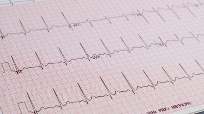 What Is an ECG Test and What Do the Results Mean? Explained Clearly